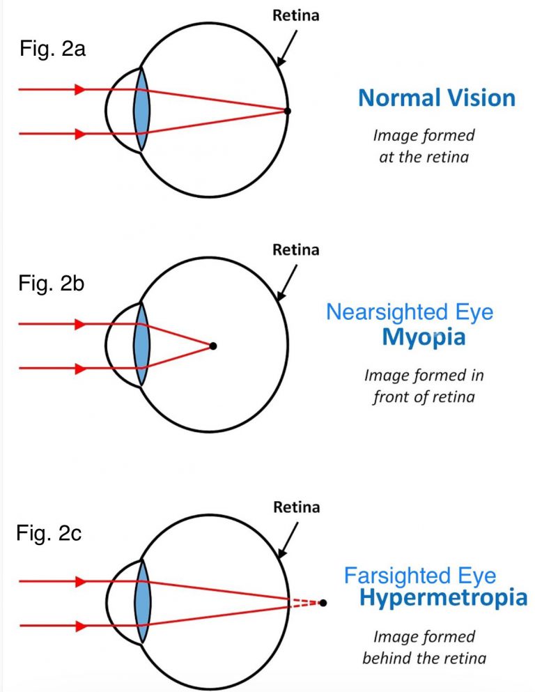 What is Presbyopia? How do I know if I have it? How can I correct it?