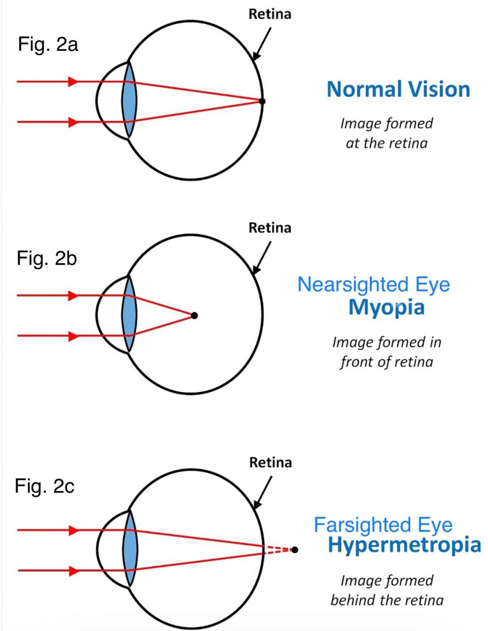 What is Presbyopia? How do I know if I have it? How can I correct it?
