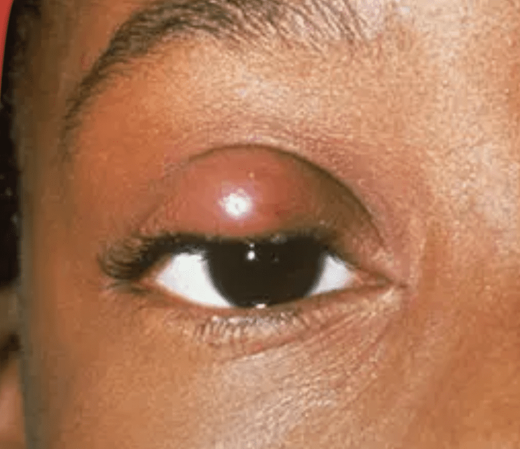 Stye vs. Chalazion - SharpeVision