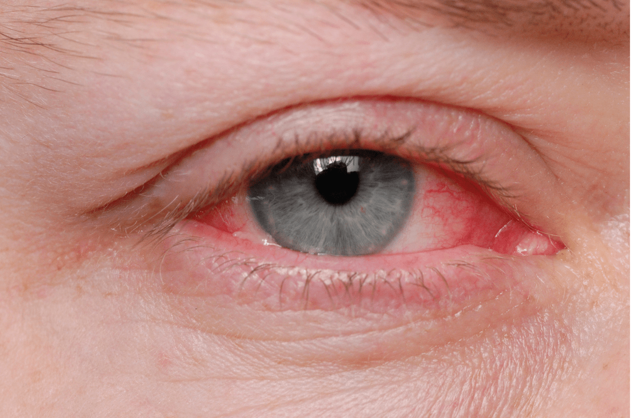 Is Conjunctivitis Airborne? - SharpeVision
